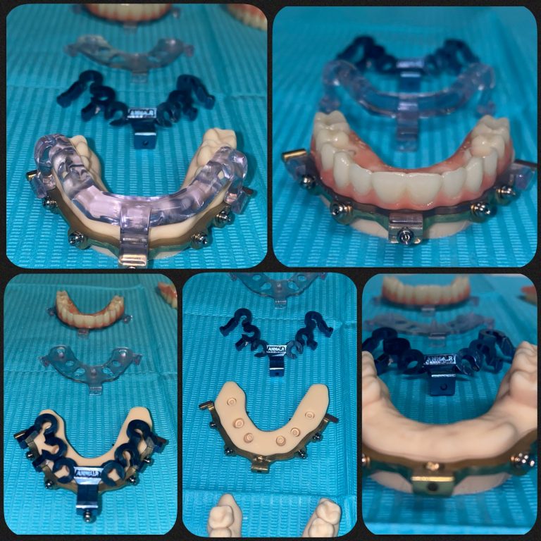 Dental Implant Restorations - Titan Surgical Systems Titan Surgical System